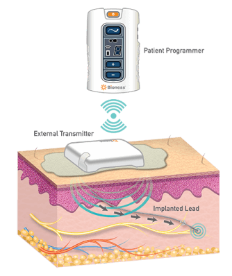 Bioness Peripheral Nerve Stimulator For Chronic Pain In Canada ...