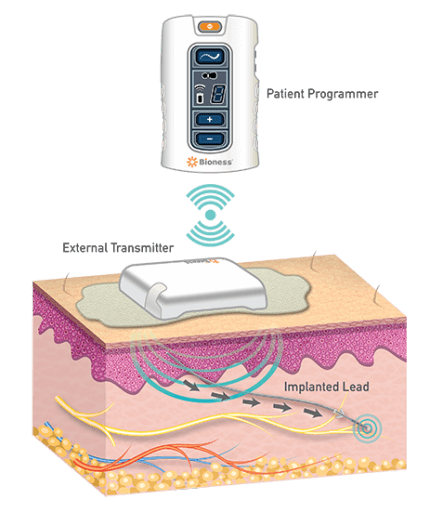Bioness Peripheral Nerve Stimulator For Chronic Pain In Canada ...